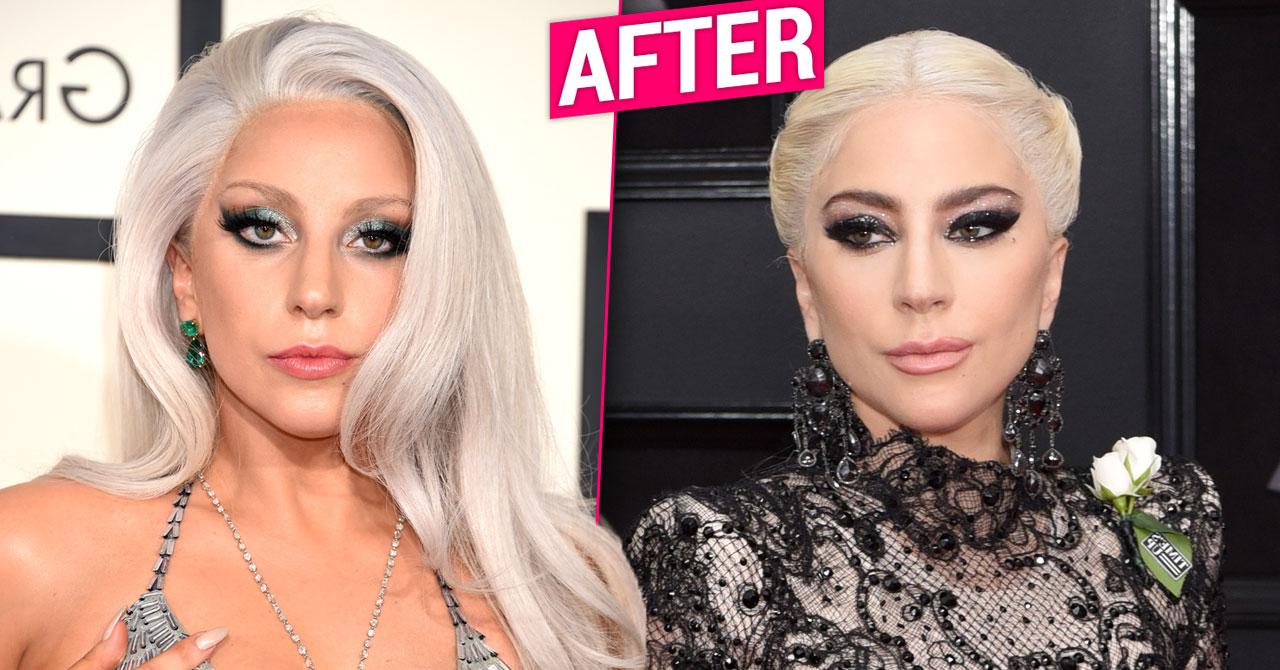 Did Lady Gaga Get Plastic Surgery For Grammys? Singer Underwent Brow ...