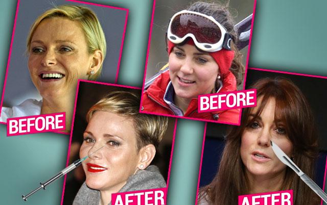 Nose Jobs, Botox & More! Royal Family Plastic Surgery Secrets