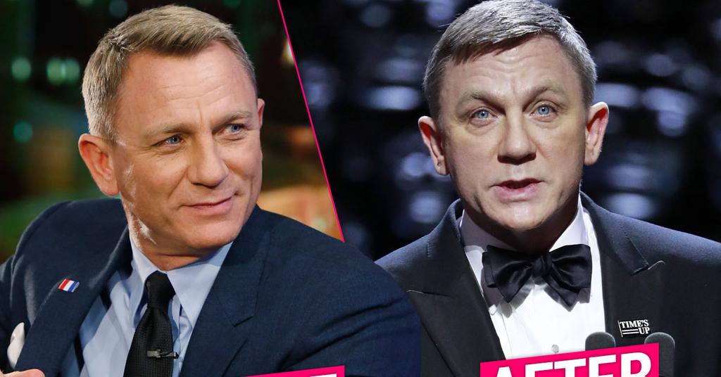 Daniel Craig Flaunts Freaky New Face After Plastic Surgery Disaster