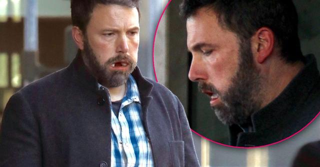 Ben Affleck Cotton Mouth Dental Surgery