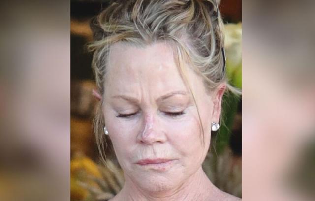 Melanie Griffith Sports Nose Scar After Skin Cancer