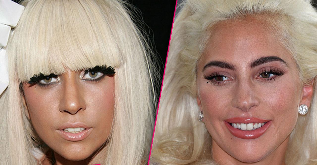 Lady Gaga's Plastic Surgery Makeover Exposed By Top Docs
