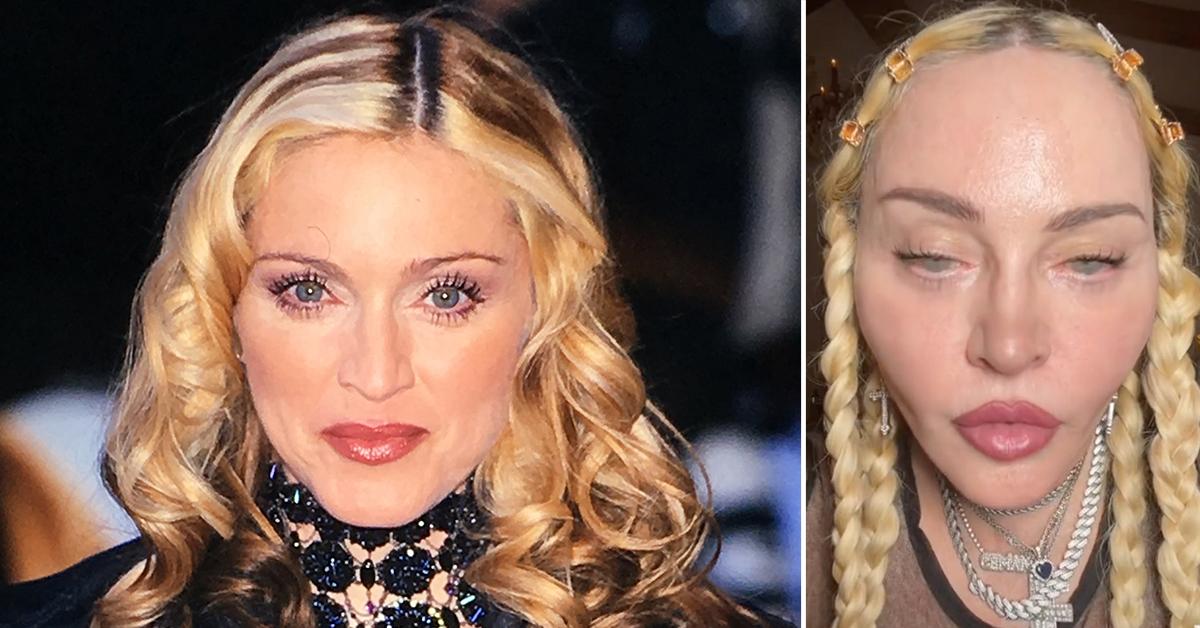 Madonna's Bizarre Face Transformation — Plastic Surgeons Weigh In