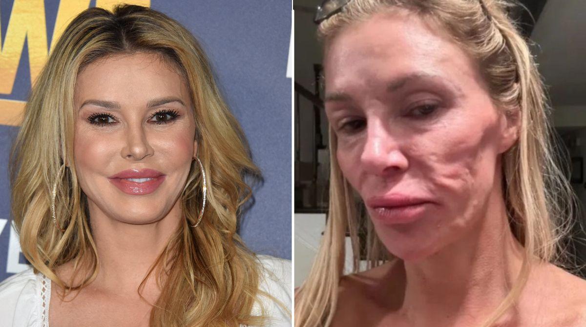 Inside Brandi Glanville's Facial Parasite Terror That Left Doctors Baffled