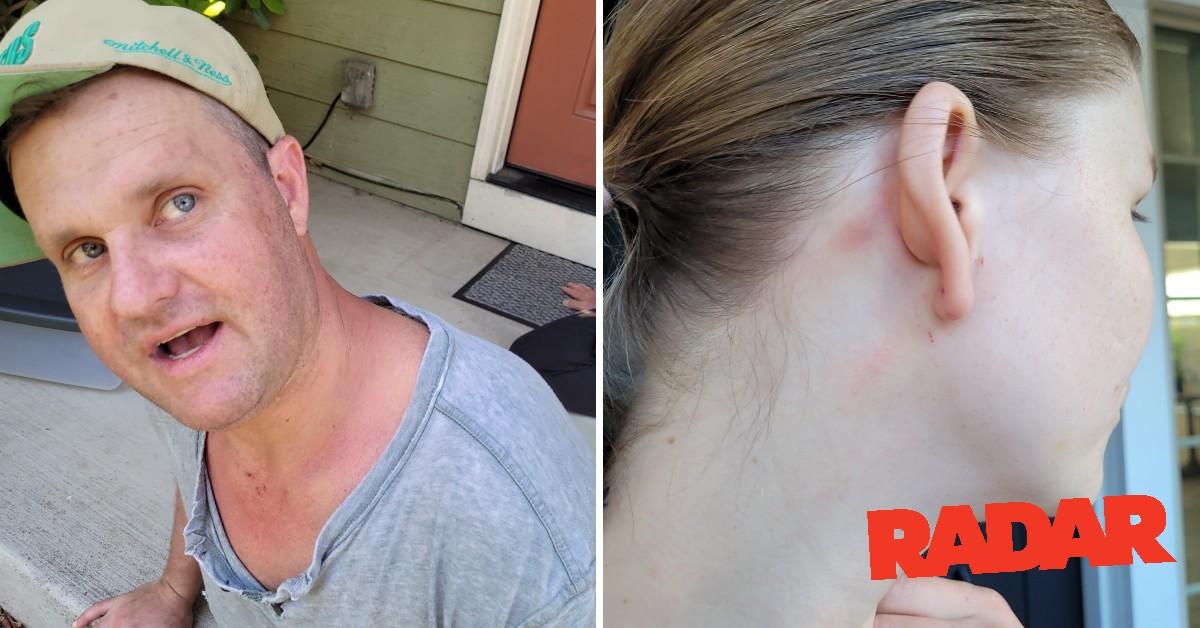 Photos: See Zachery Ty Bryan and His Ex's Injuries After Domestic ...