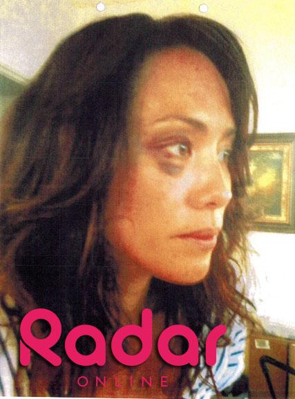 Michelle Ghent Shows Injuries Sustained At The Hand Of Terrence Howard