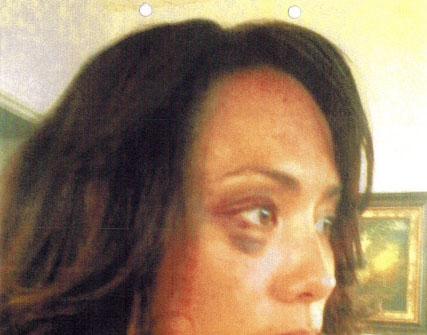 Michelle Ghent Shows Injuries Sustained At The Hand Of Terrence Howard