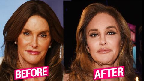 Caitlyn Jenner Unveils Freaky Face Amid Claims Of MORE Surgery