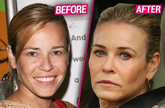 Had A Facelift, Lately?! Chelsea Handler's Frozen Face EXPOSED — Before ...