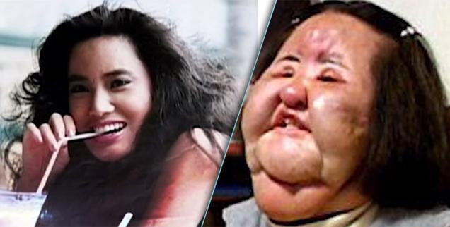 18 Extreme Real Life Plastic Surgery Disasters