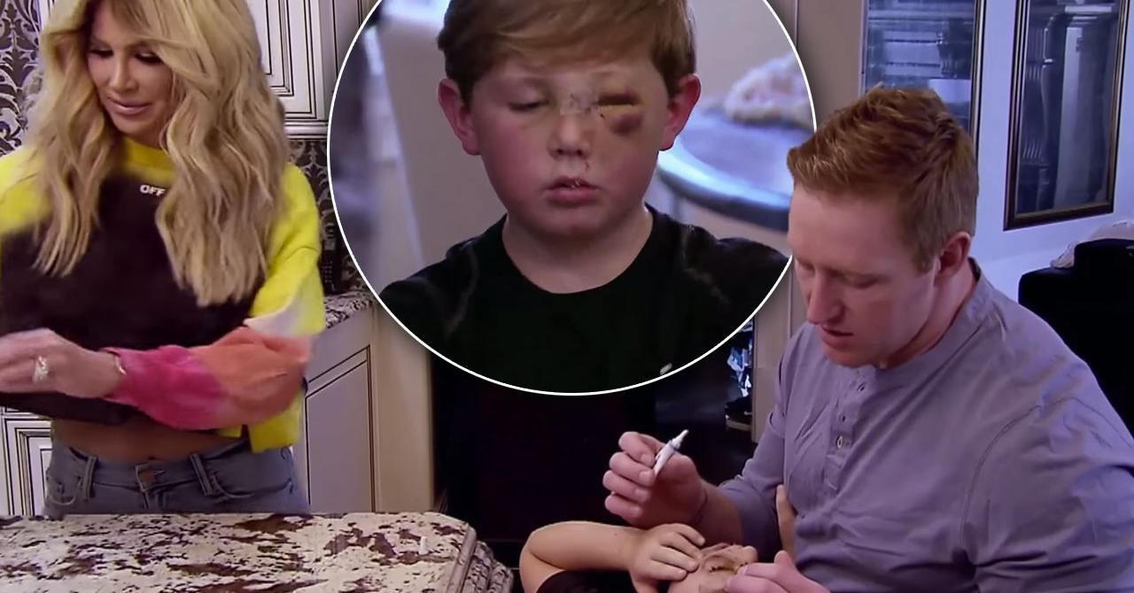 Kash Biermann Deals With Painful Eye Injury After Dog Bite