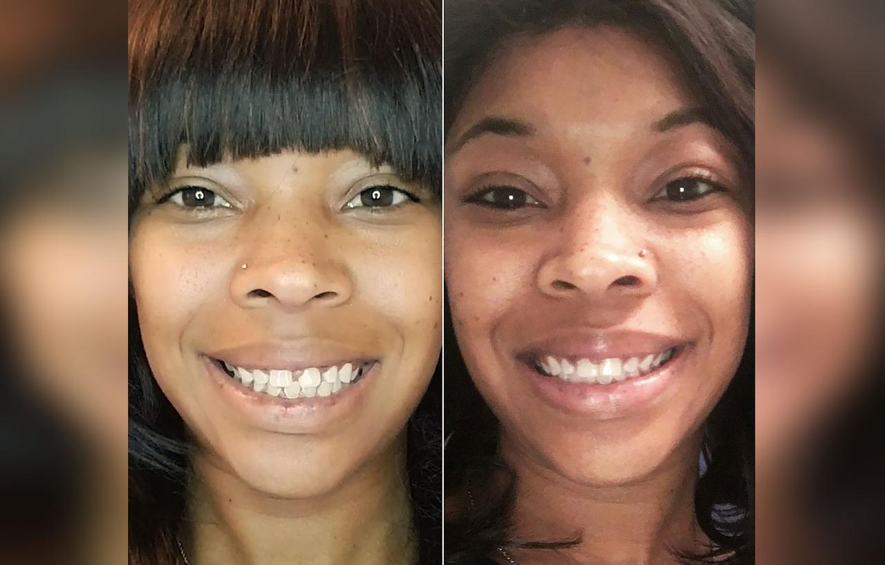 Need To Re-Straighten Your Smile Post-Braces? Shop Byte Now!