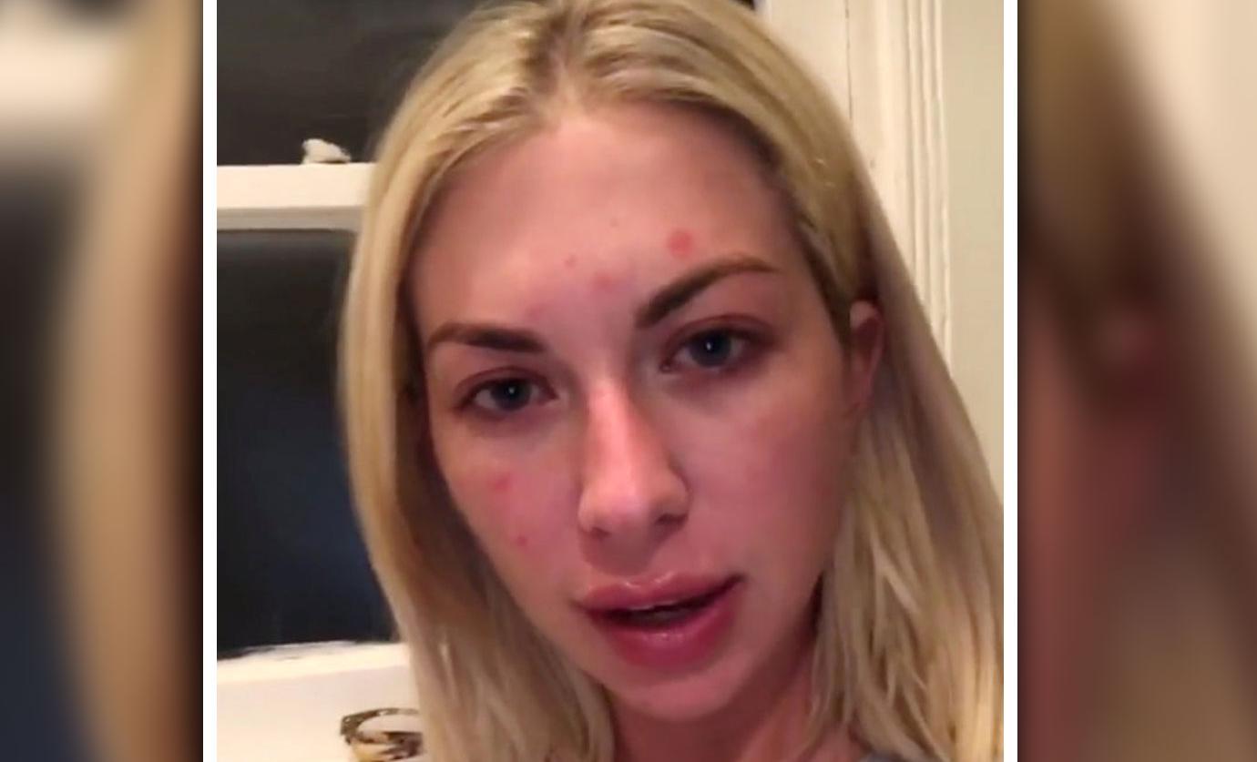 Stassi Schroeder Reveals Psoriasis Make Up Free Photo