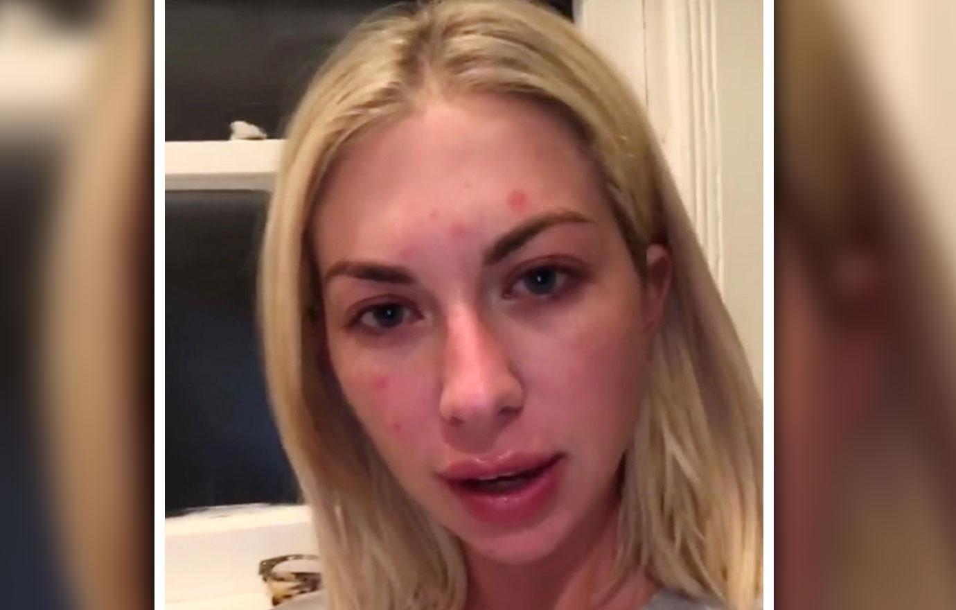 Stassi Schroeder Reveals Psoriasis Make Up Free Photo