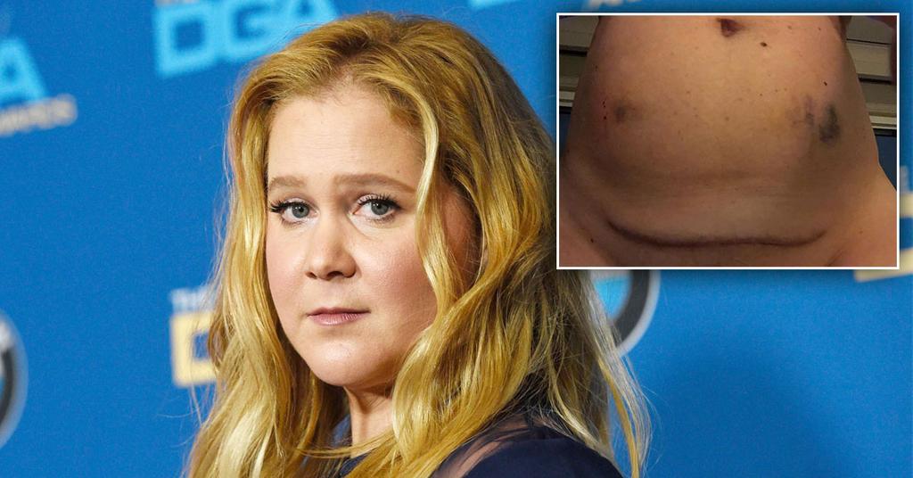 Amy Schumer Says She's ‘Run Down’ Amid IVF Treatment