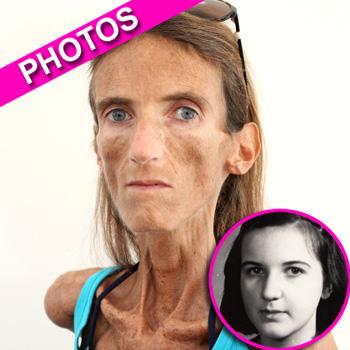 Heartbreaking Tale Of 'World's Thinnest Woman' Campaigning Against ...
