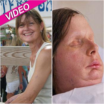 Charla Nash Reveals Face Transplant After Brutal Chimp Attack