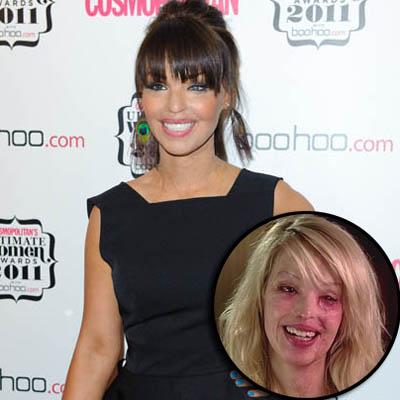 Acid Attack Survivor Katie Piper: ‘I Have Learned To Love My Face Again’