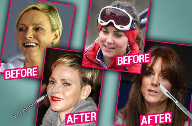 Nose Jobs, Botox & More! Royal Family Plastic Surgery Secrets