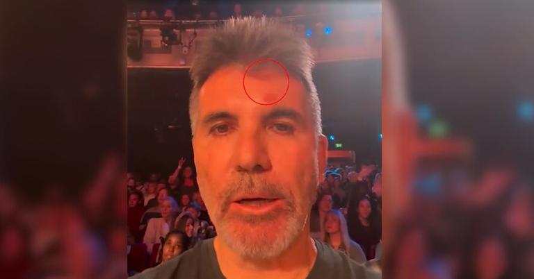 Simon Cowell Shows Off Head Injury After Suffering Nasty Fall