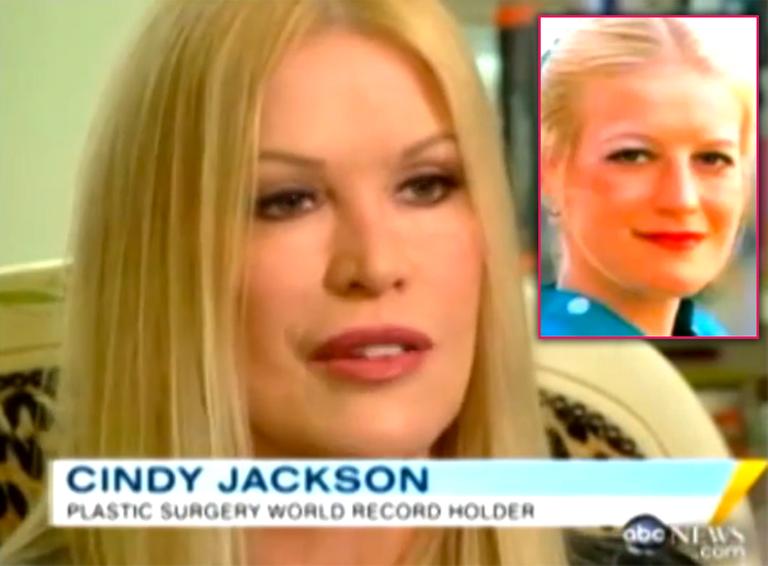 18 Extreme Real Life Plastic Surgery Disasters