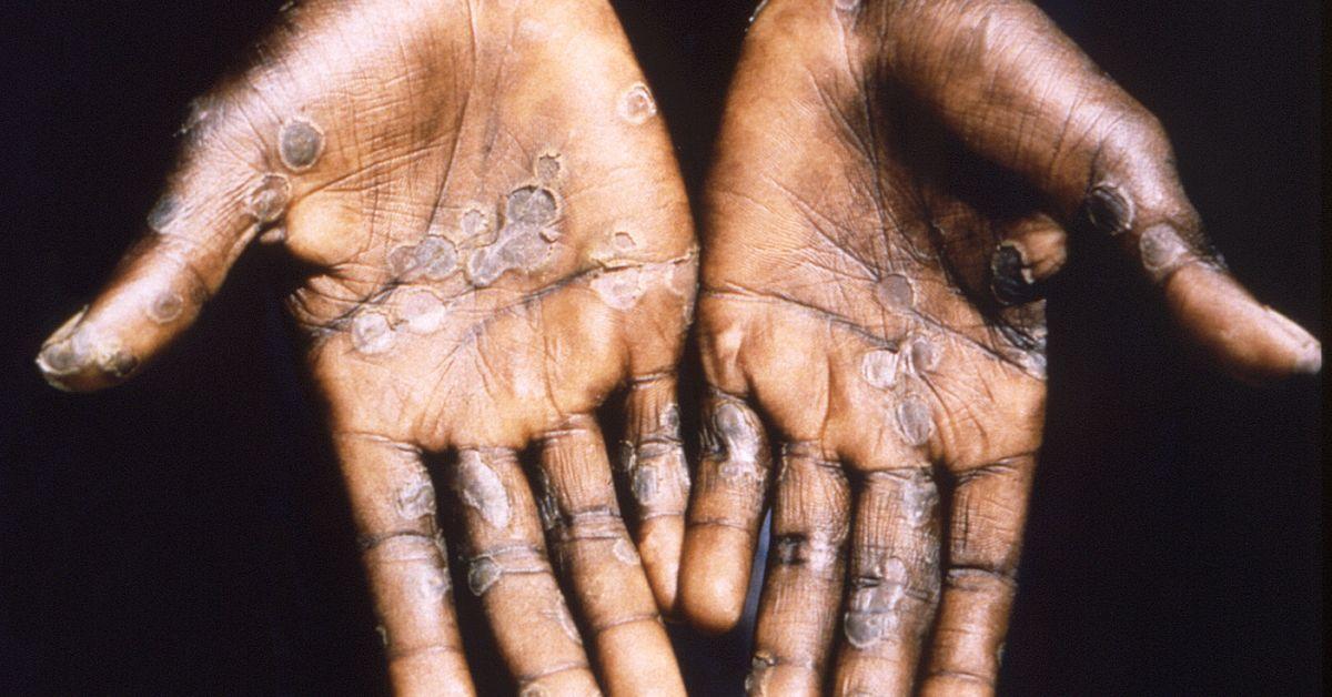 Patient's Nose ROTS OFF After Contracting Monkeypox