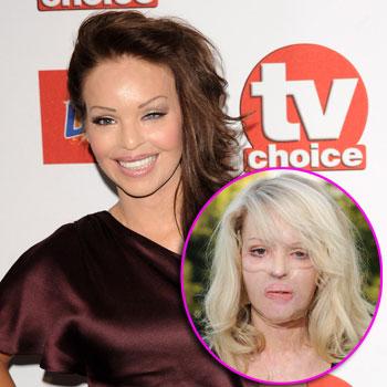Former Model Acid Attack Victim Katie Piper Reveals Her Miraculous Recovery