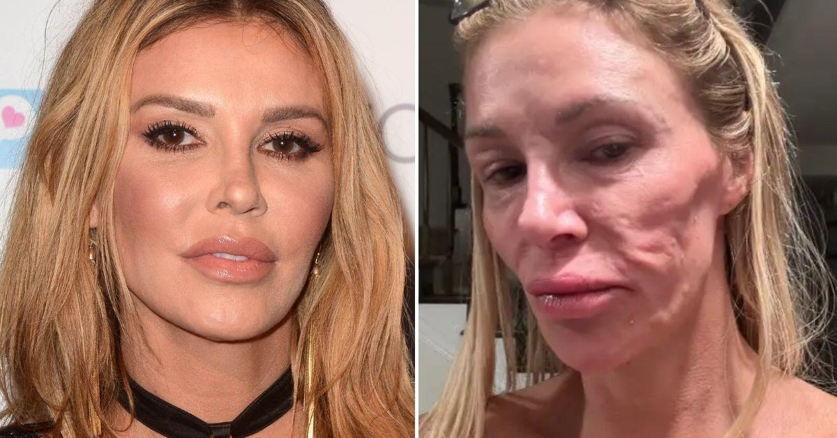 Brandi Glanville Spent Over $70K To Treat Facial Parasite Disfigurement Brandi Glanville Spent Over $70K To Treat Facial Parasite Disfigurement