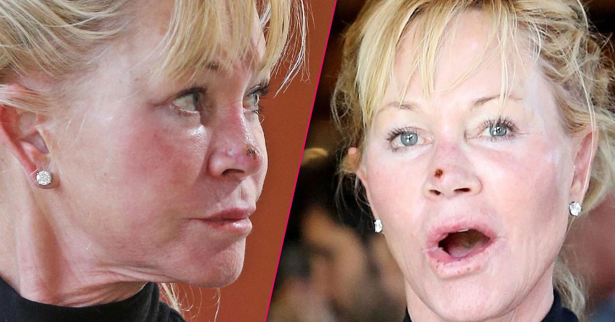Melanie Griffith Steps Out With Scab On Her Nose