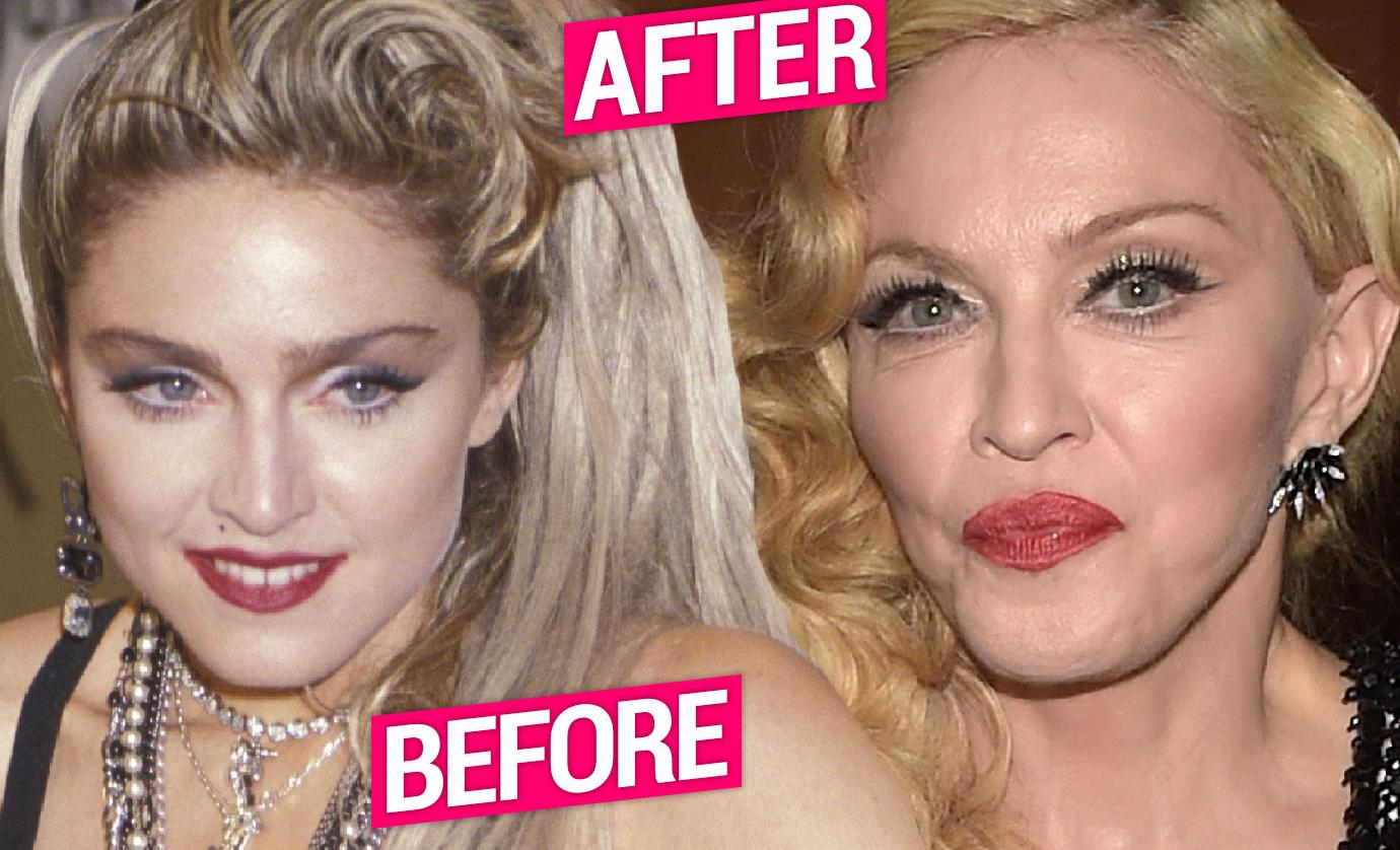 Madonna Plastic Surgery Secrets Revealed
