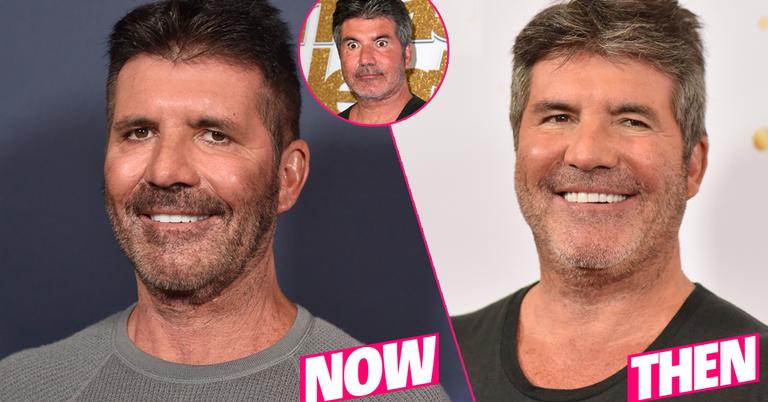 Simon Cowell Plastic Surgery Makeover Exposed By Top Docs