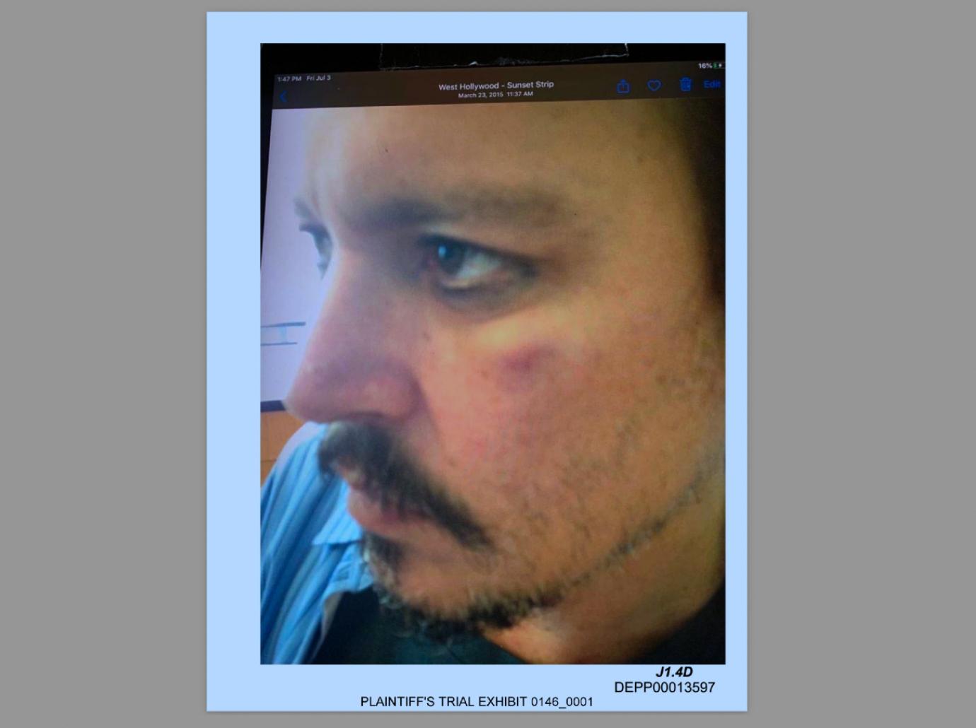 Johnny Depp Reveals Photos Of Alleged Injuries From Amber Heard Fights