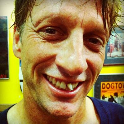 Tony Hawk Shows Off Gnarly Smile After Skateboarding Accident