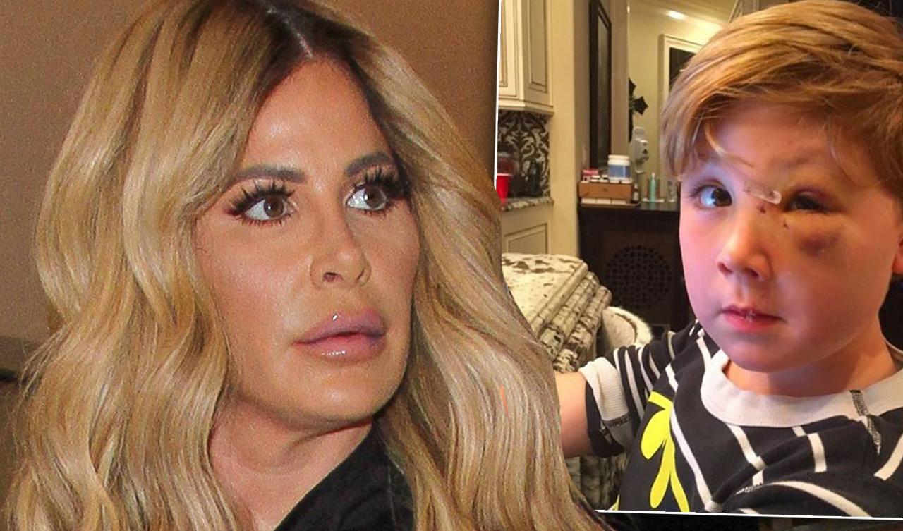 [PIC] Kim Zolciak’s Son Kash Biermann Recovering After Dog Bite