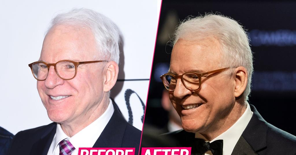 Plastic Surgeons Reveal Steve Martin's Secrets To Youthful Look
