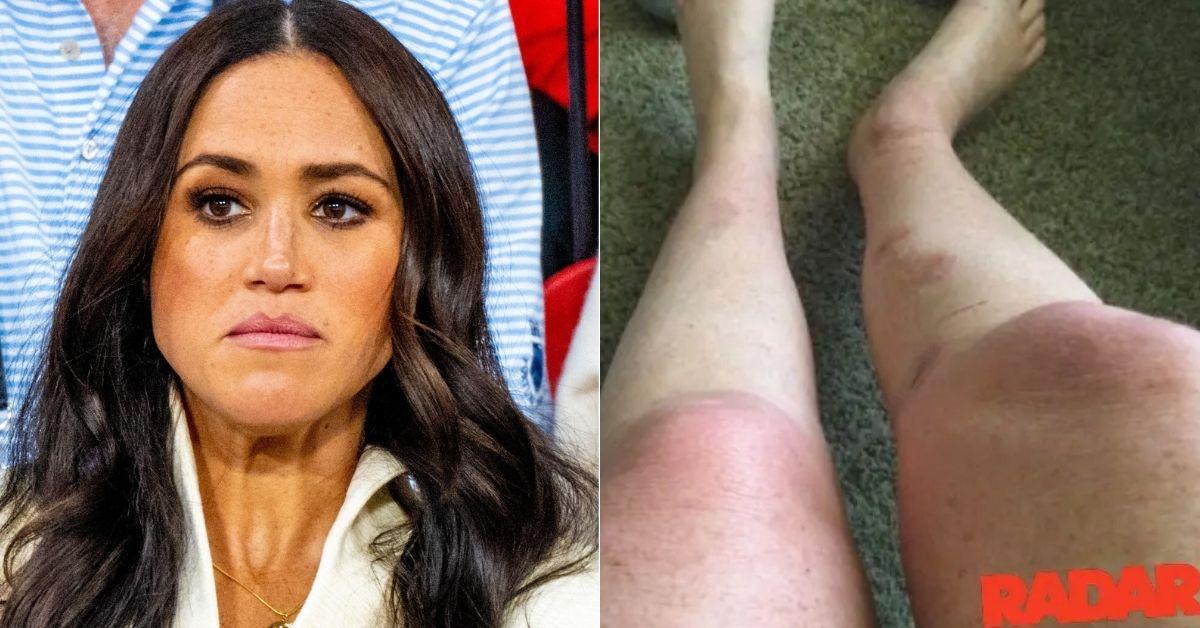 Burn Victim Claims Meghan Markle Knew About Labelling Responsibilities