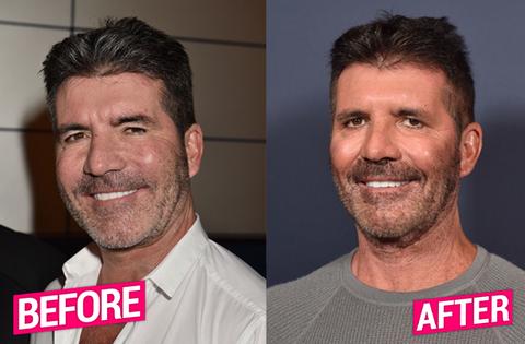 Simon Cowell Plastic Surgery Makeover Exposed By Top Docs