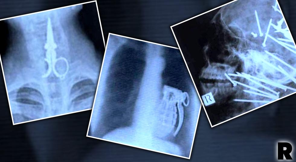 Inside Story! Weird Objects & Horrifying Injuries Caught On X-Ray!