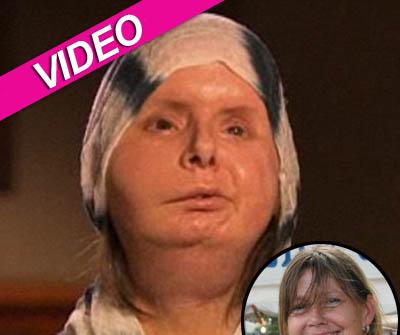 Chimp Attack Victim Charla Nash: New Face ‘Has Really Given Me A Life Back’