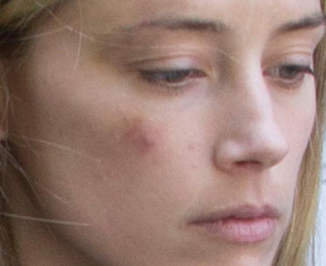Sobbing And Bruised Amber Heard Granted Depp Restraining Order