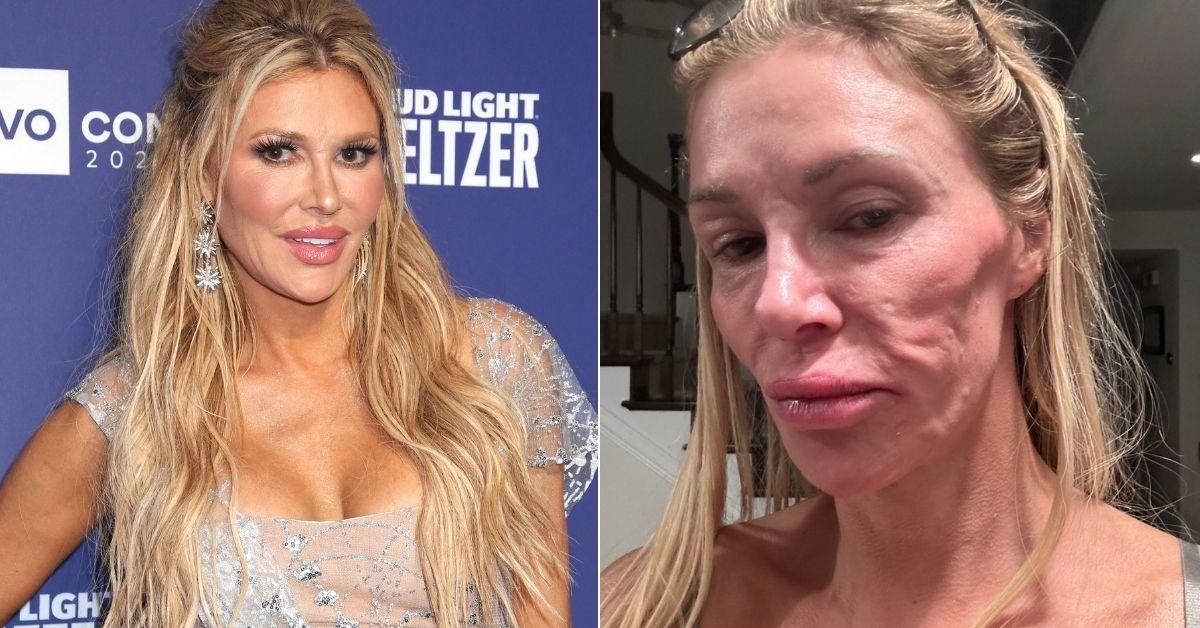 ‘Botched’ Surgery Expert Issues Bleak Warning to Tormented ‘Housewives’ Star Brandi Glanville ...