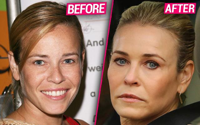 Had A Facelift, Lately?! Chelsea Handler's Frozen Face EXPOSED — Before ...