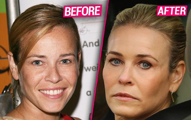 Had A Facelift, Lately?! Chelsea Handler's Frozen Face EXPOSED — Before ...
