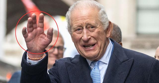 EXCLUSIVE: Why Cancer-Battling King Charles' Fingers are So Swollen