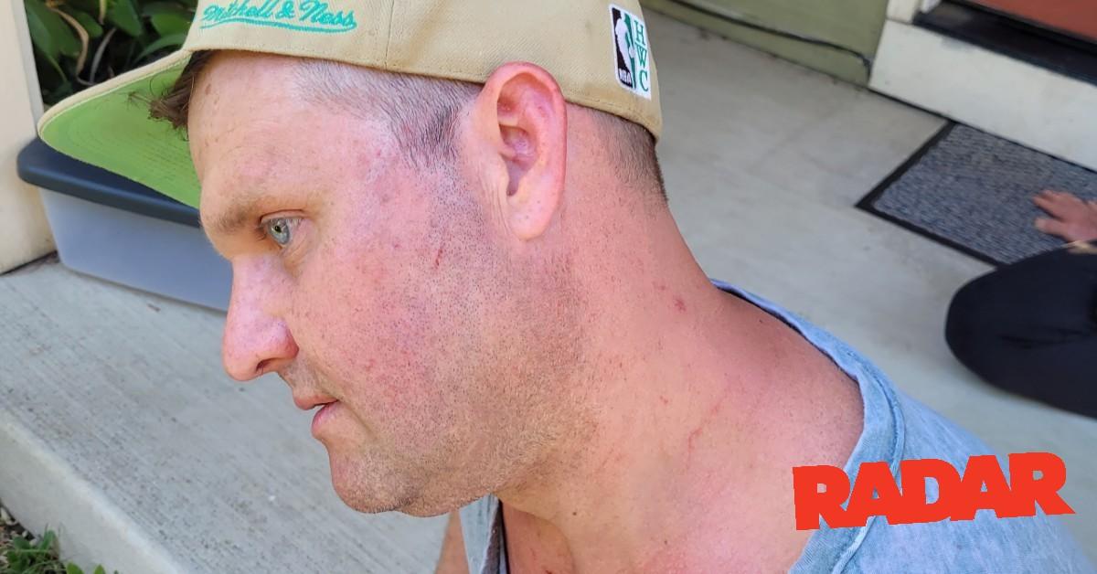 Photos: See Zachery Ty Bryan and His Ex's Injuries After Domestic ...