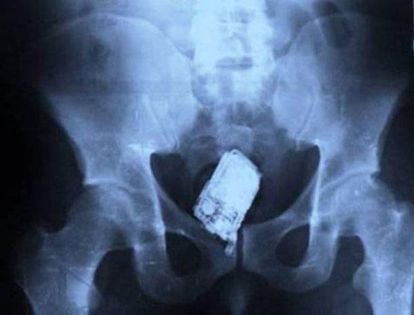 Inside Story! Weird Objects & Horrifying Injuries Caught On X-Ray!