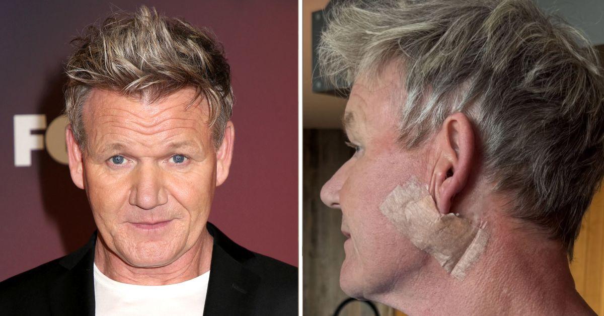 Gordon Ramsay Reveals Brutal Stitched-Up Face After Cancer Shock
