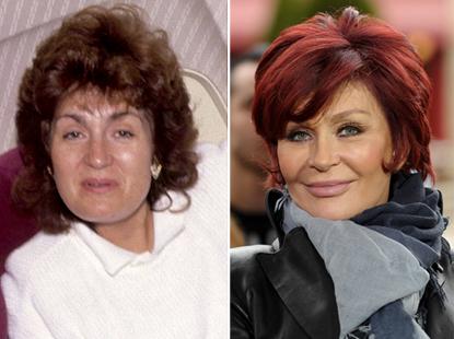 PHOTOS: 10 Celebrities Addicted To Plastic Surgery