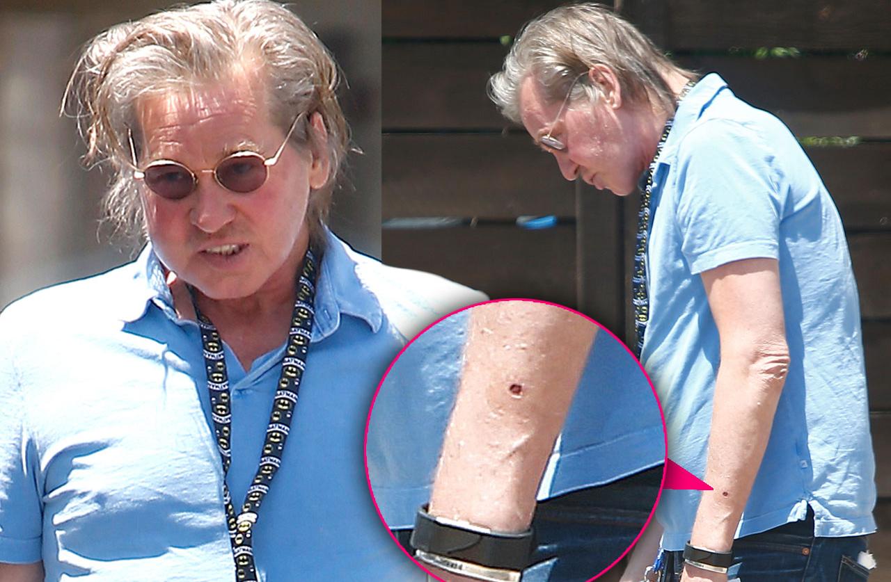 Val Kilmer Flesh Eating Cancer Scare