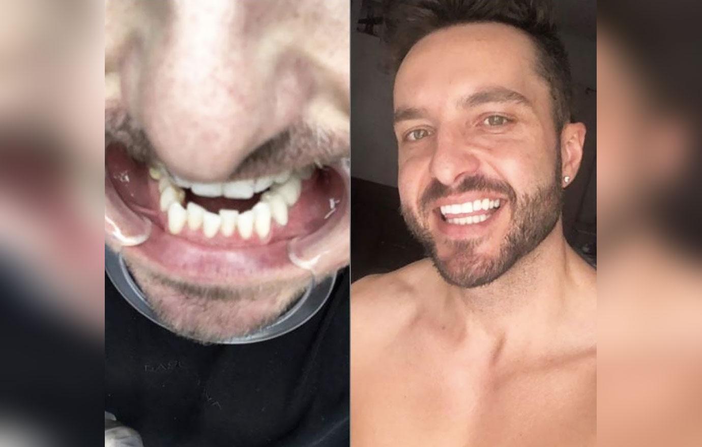 Need To Re-Straighten Your Smile Post-Braces? Shop Byte Now!